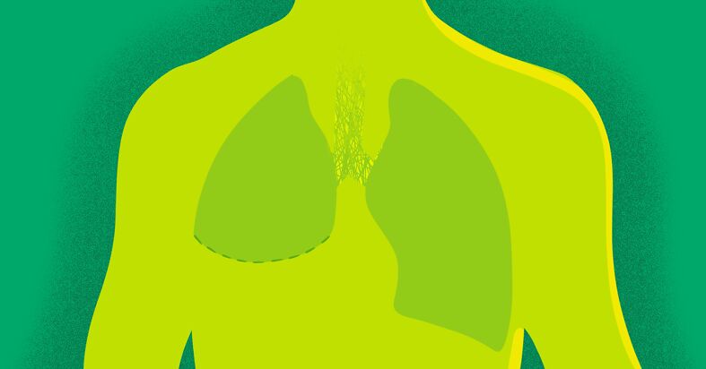 Lobectomy for Lung Cancer: A Patient's Story | LungCancer.net