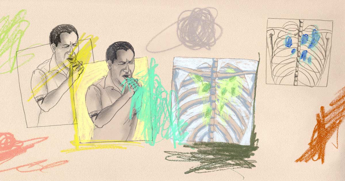 How Is Sputum Cytology Used For Lung Cancer Diagnosis?